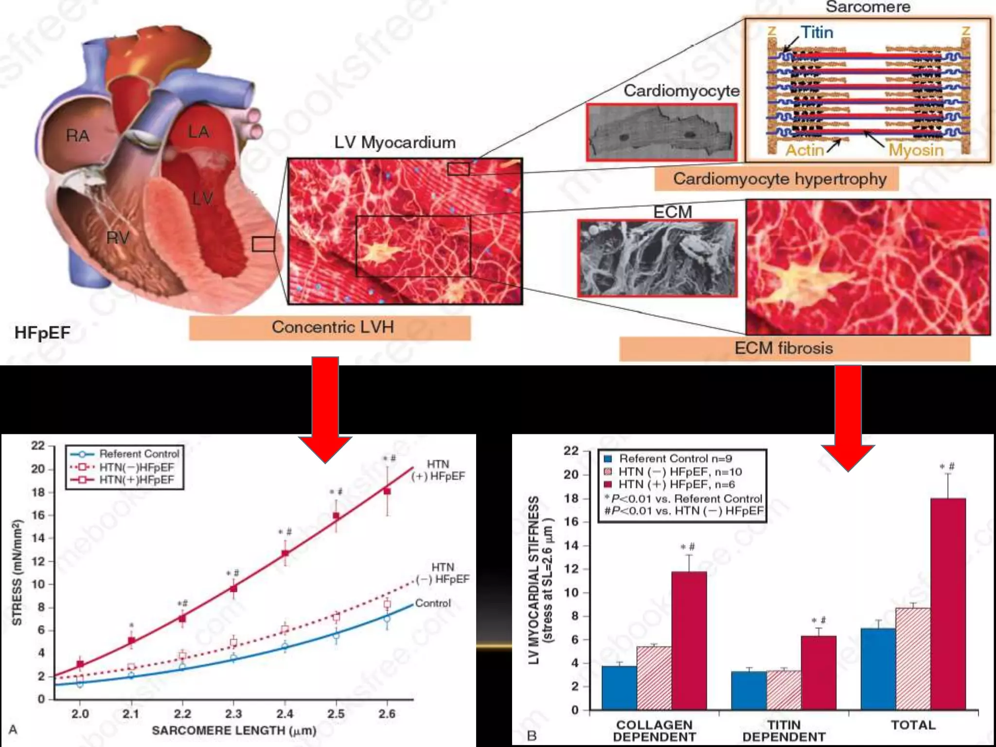 Heart failure with preserved ejection fraction | PPTX