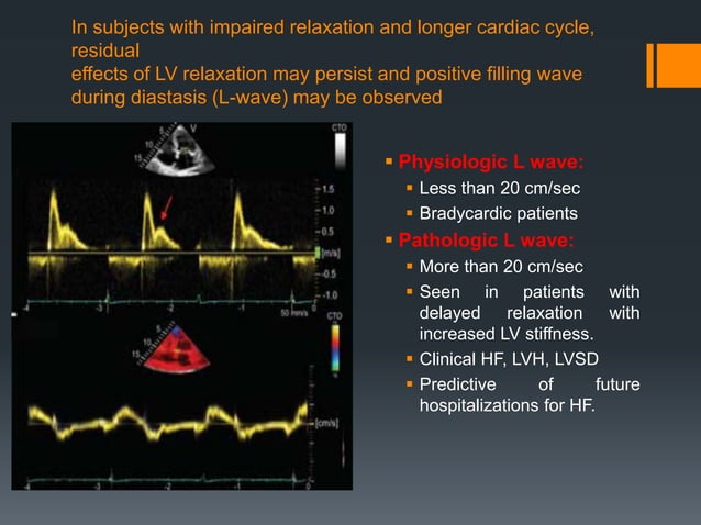 Heart failure with preserved ejection fraction | PPTX