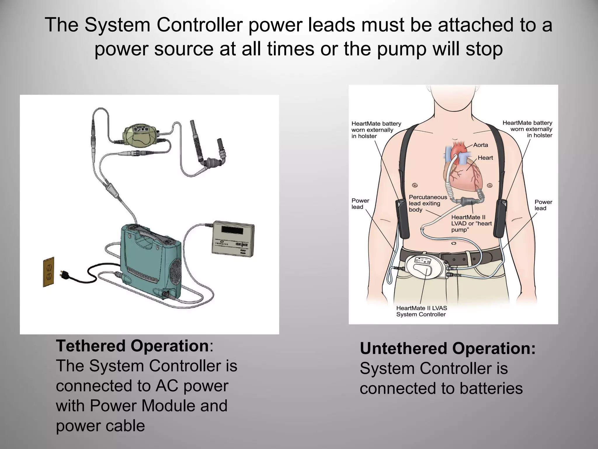Heart mate ii lvad basic user updated per moses cone | PPT