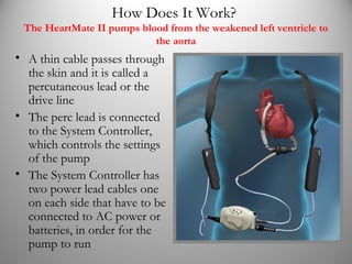 Lvad Heartmate Ii