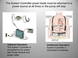 Heartmate Ii Lvad Pump Advertisement
