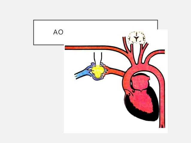 Aortal and mitral heart defects. Clinical fpattern | PPT