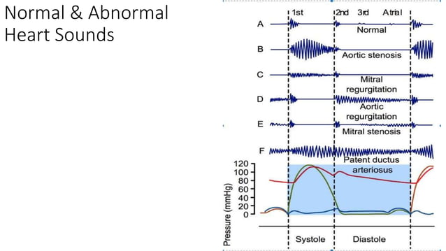 Heart murmurs | PPT