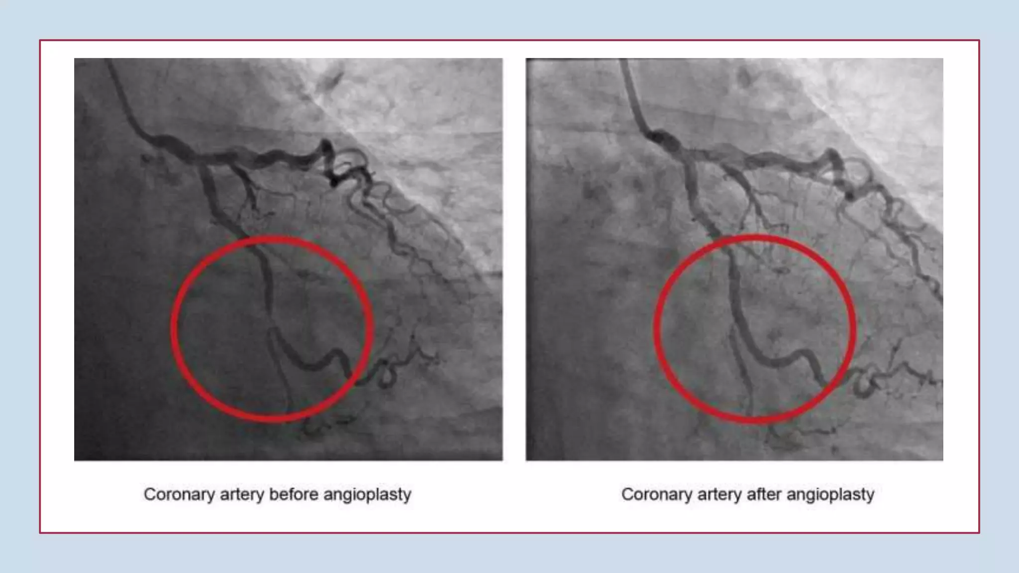 Coronary Angiography and PTCA | PPTX