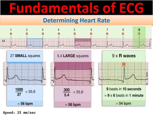 Approach to a patient with Heart rate abnormality in ECG | PPT