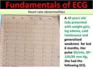 Abnormal Ecg Heart Disease