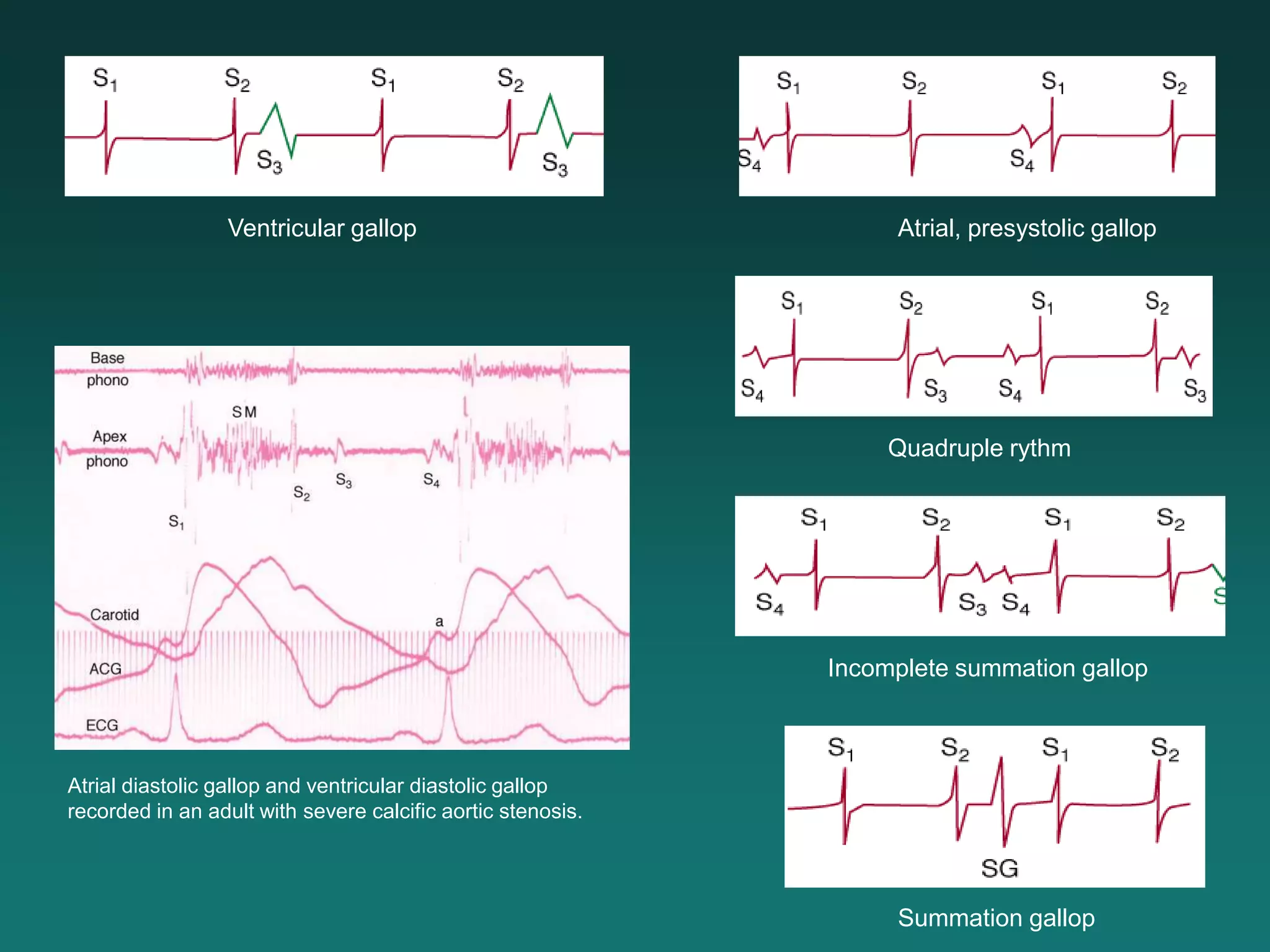 Heart sound auscultation.ppt