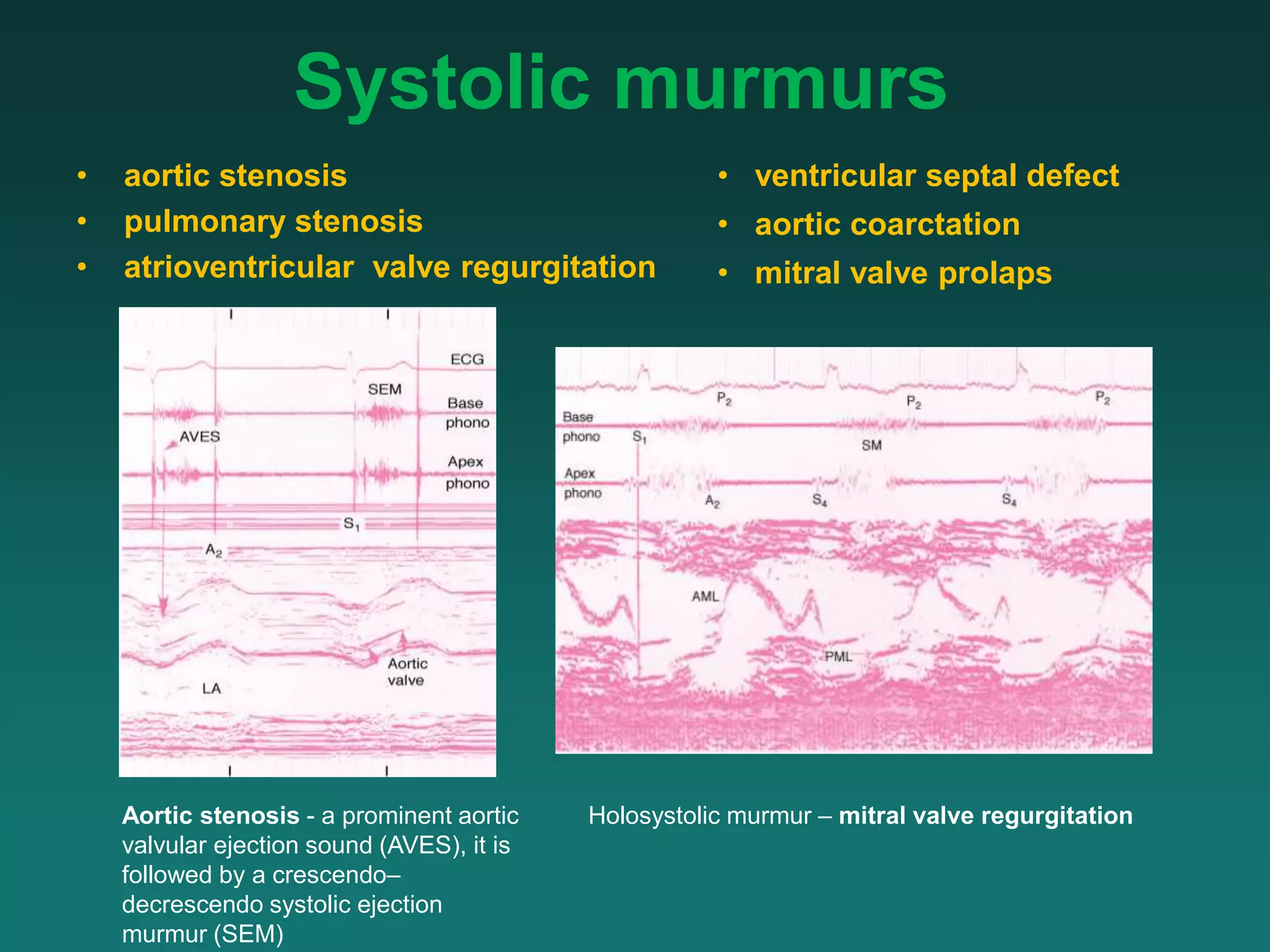 Heart sound auscultation.ppt