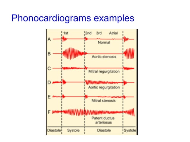 Heart sounds topic cardio vascular system | PDF | Heart and ...
