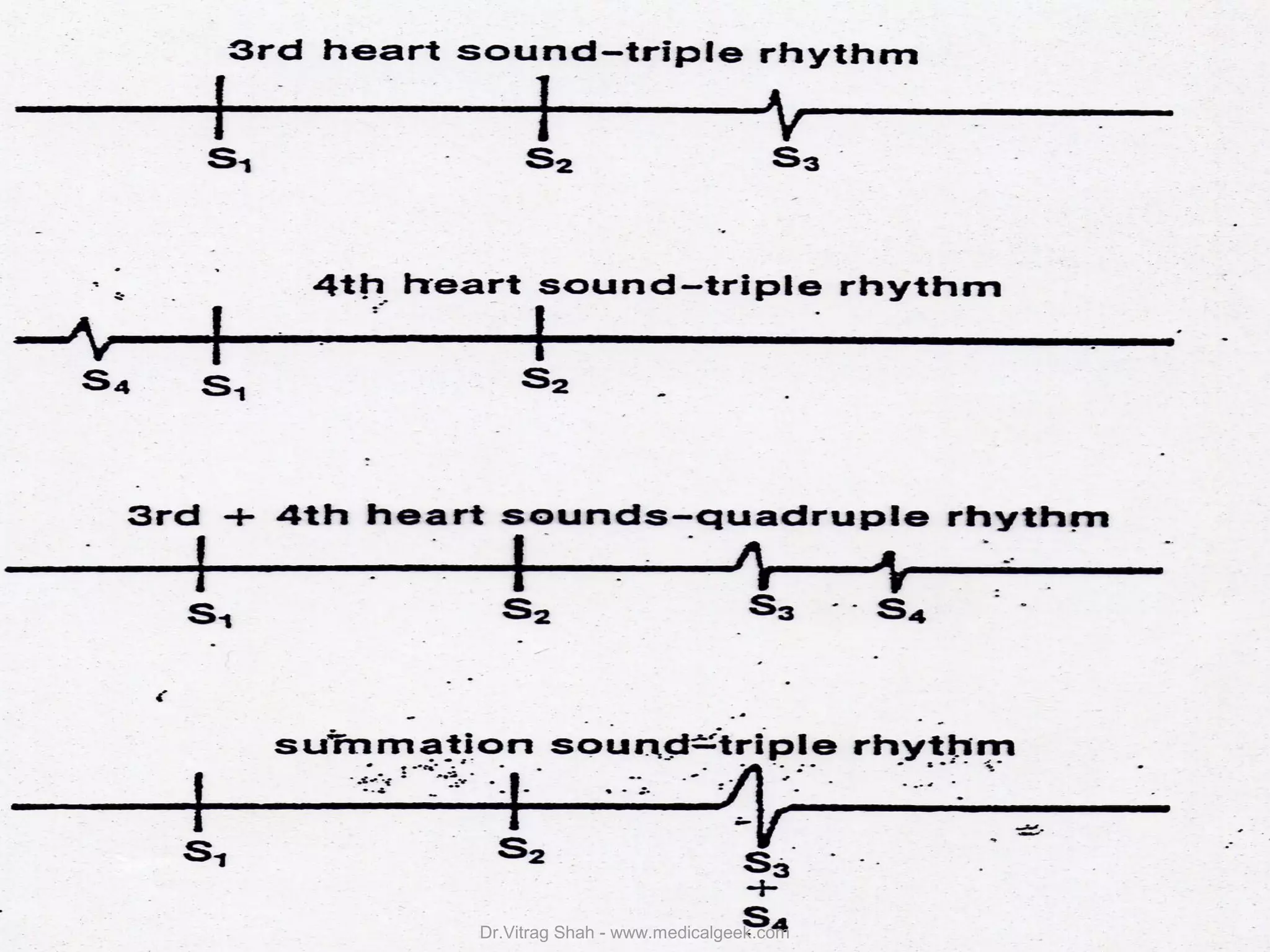 Heart sounds and murmur | PDF