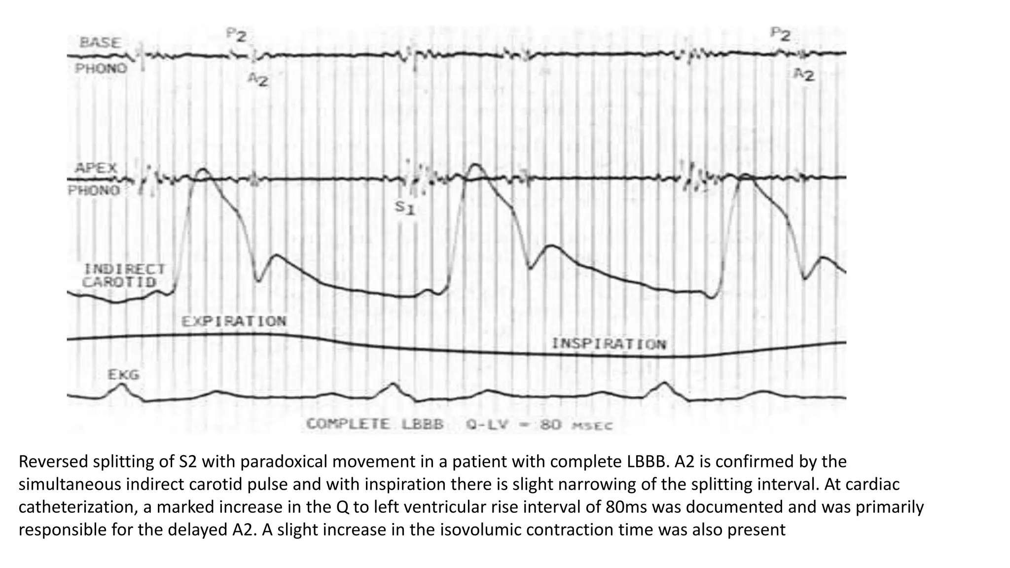 Heart sounds,murmurs & Dynamic auscultation.pptx