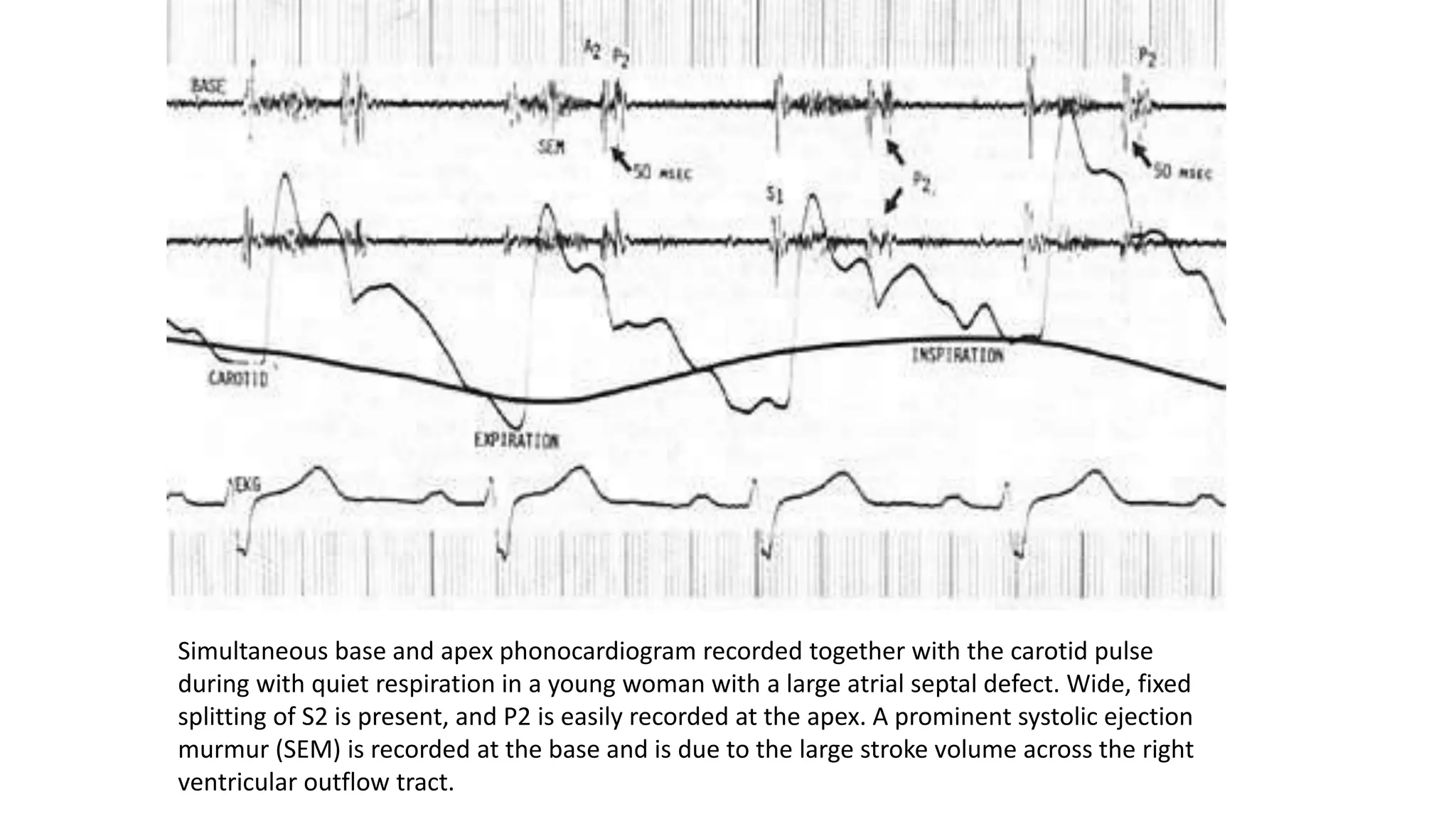 Heart sounds,murmurs & Dynamic auscultation.pptx