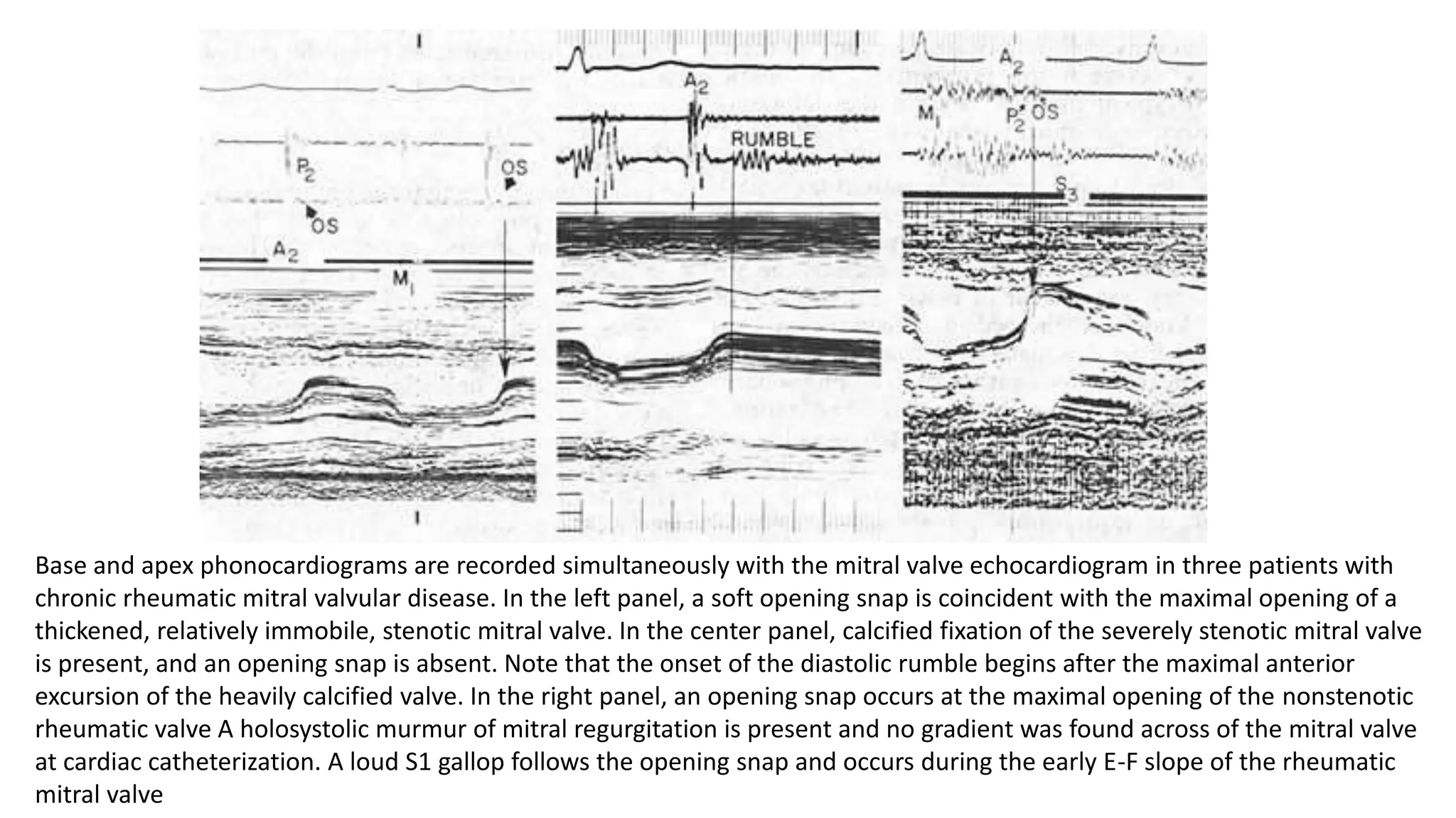 Heart sounds,murmurs & Dynamic auscultation.pptx