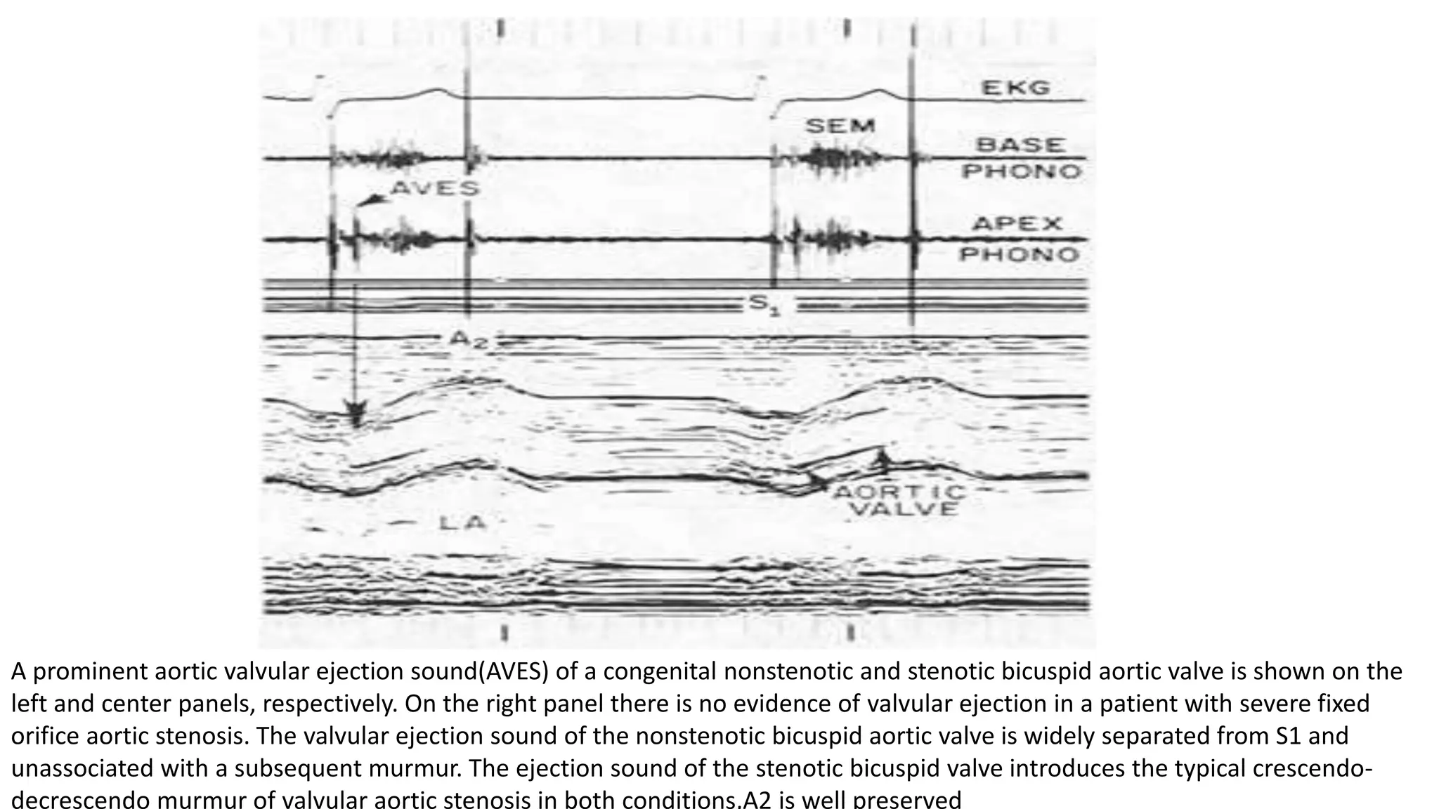 Heart sounds,murmurs & Dynamic auscultation.pptx
