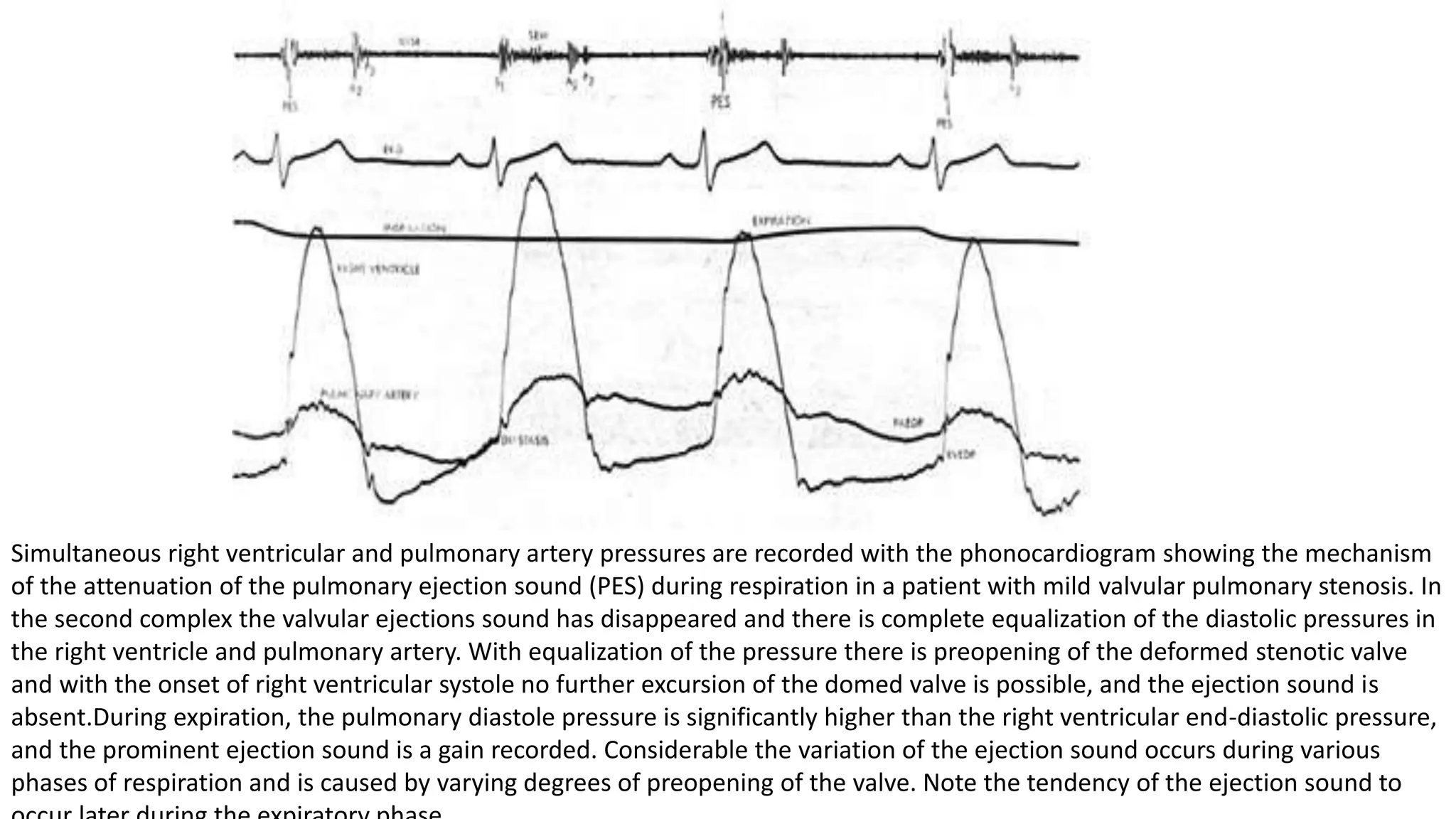 Heart sounds,murmurs & Dynamic auscultation.pptx