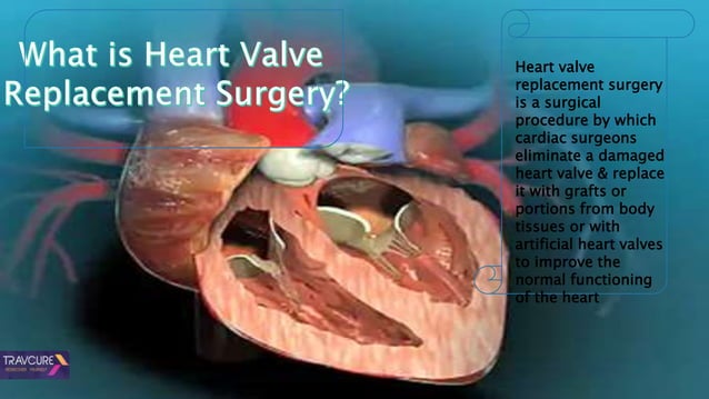 Heart valve replacement surgery procedure | PPTX | Heart and ...
