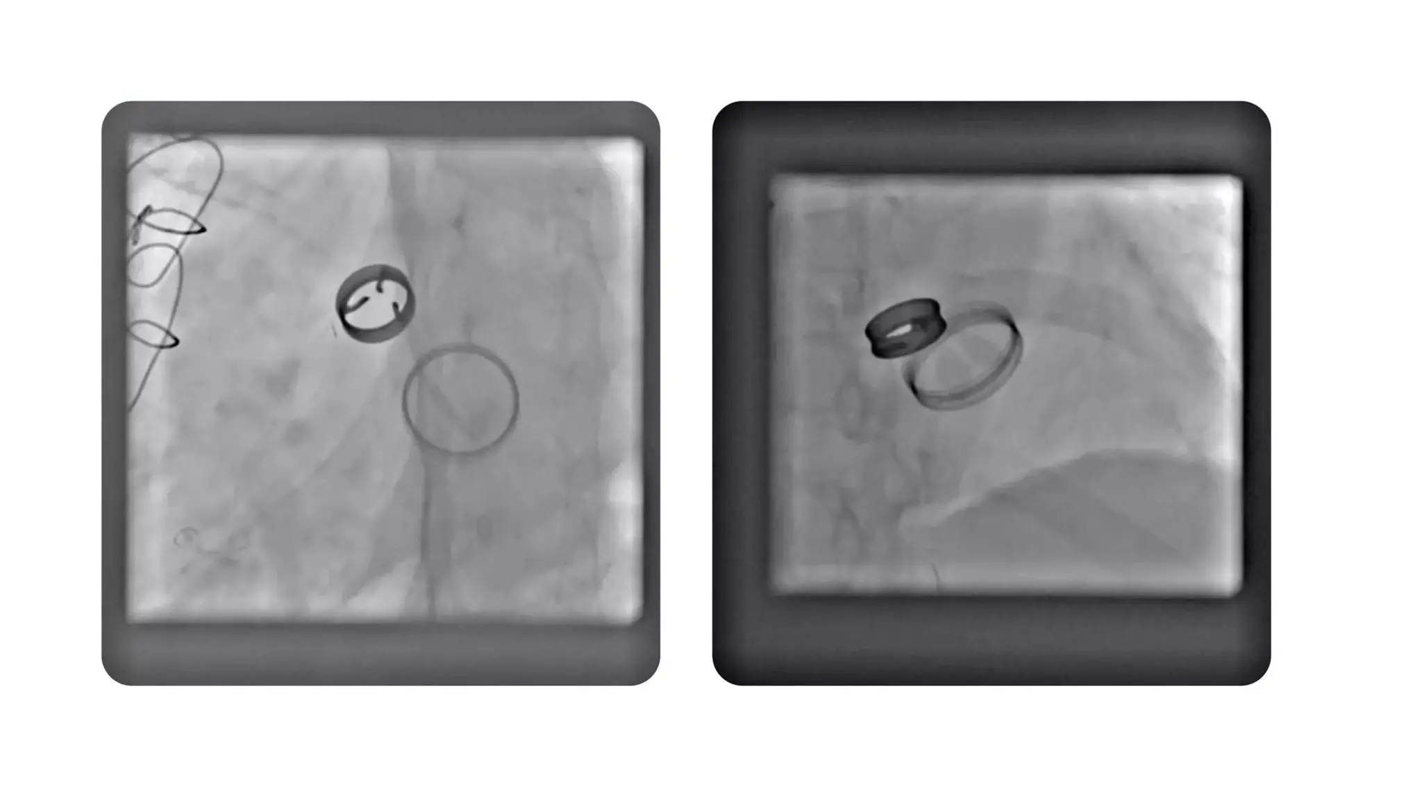 ANATOMY OF HEART VALVES AND PROSTHETIC VALVES.pptx