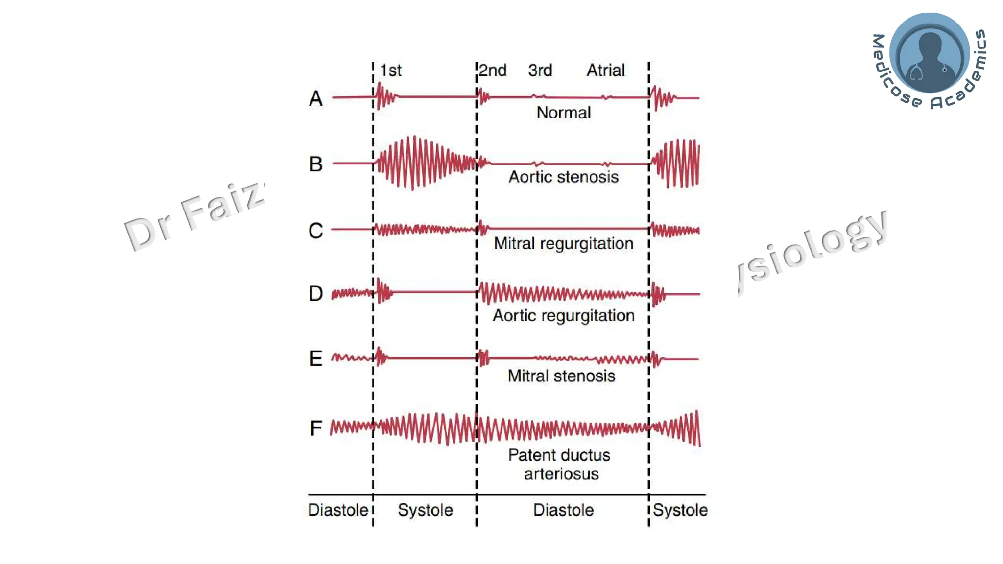 Heart Valves and Heart Sounds -Congenital & valvular heart disease.pdf
