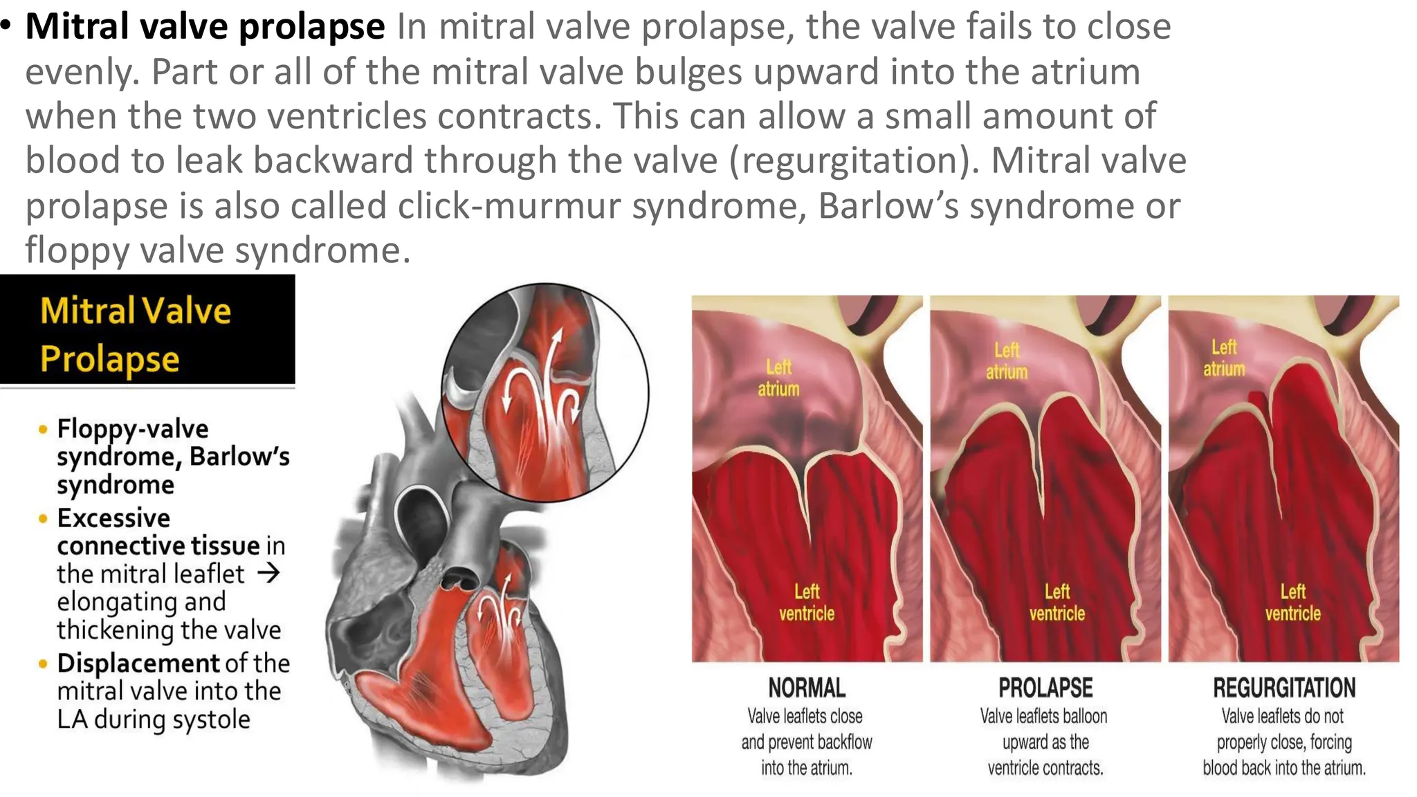 Heart Valves Disease (Mitral valve stenosis, Pumonary valve stenosis ...