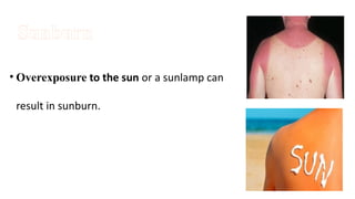 Heat Emergencies & Heat Exhaustion&Heat Stroke.pptx