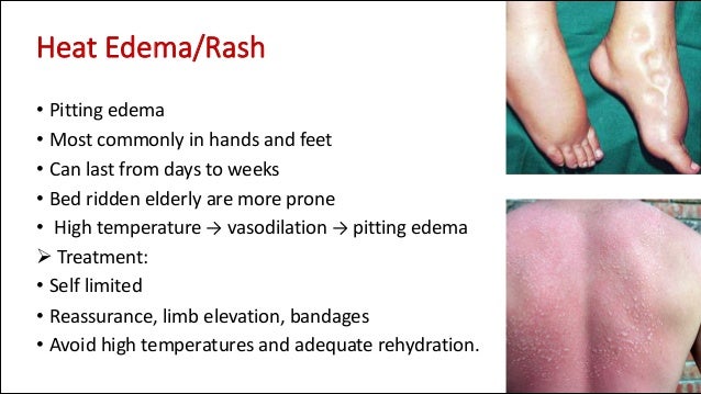 Heat Related Disorders