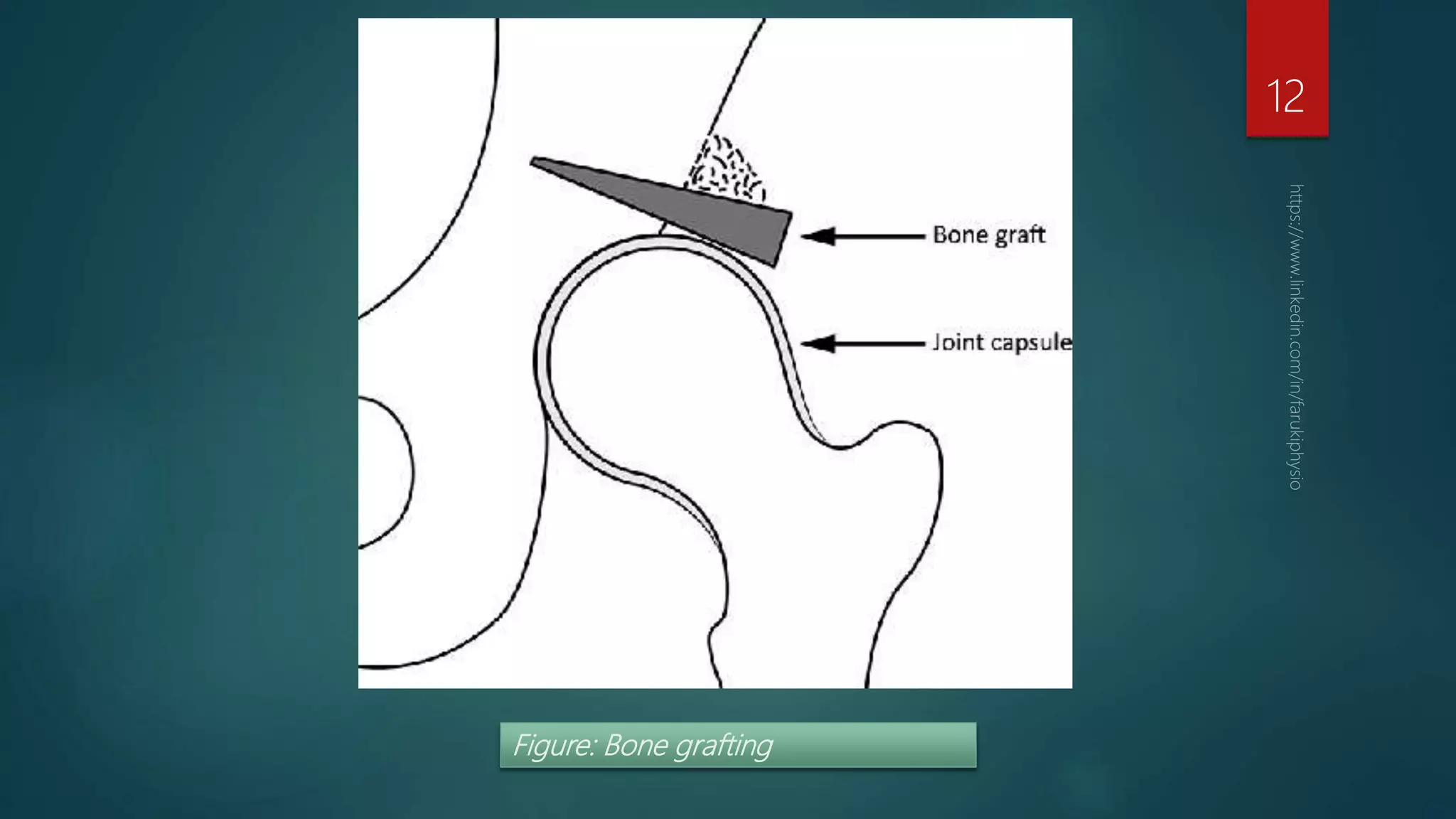 Bone grafting(PT) | PPTX