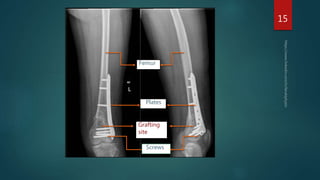 Bone grafting(PT) | PPTX