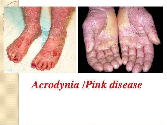 Heavy metal and human health