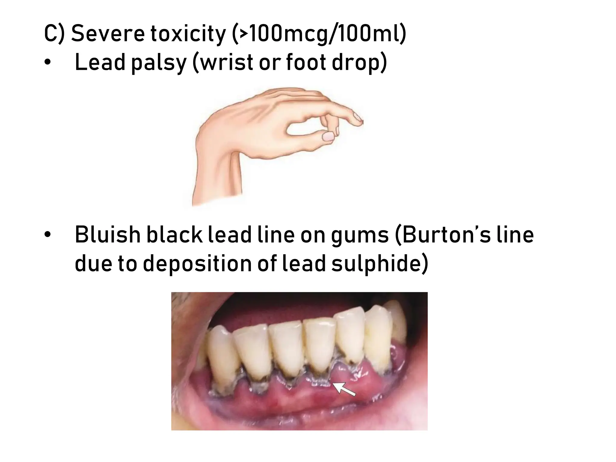 clinical features and management of heavy metal poisoning .pptx