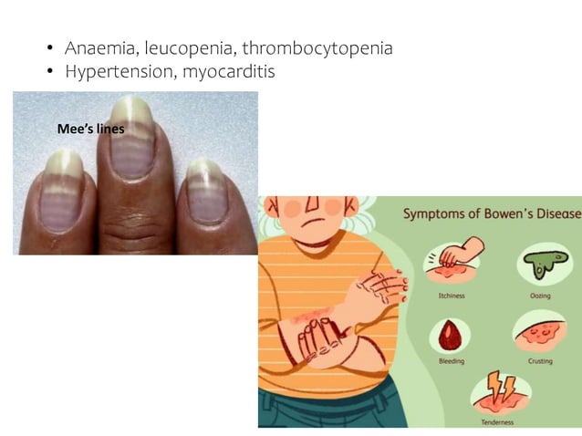 clinical features and management of heavy metal poisoning .pptx ...