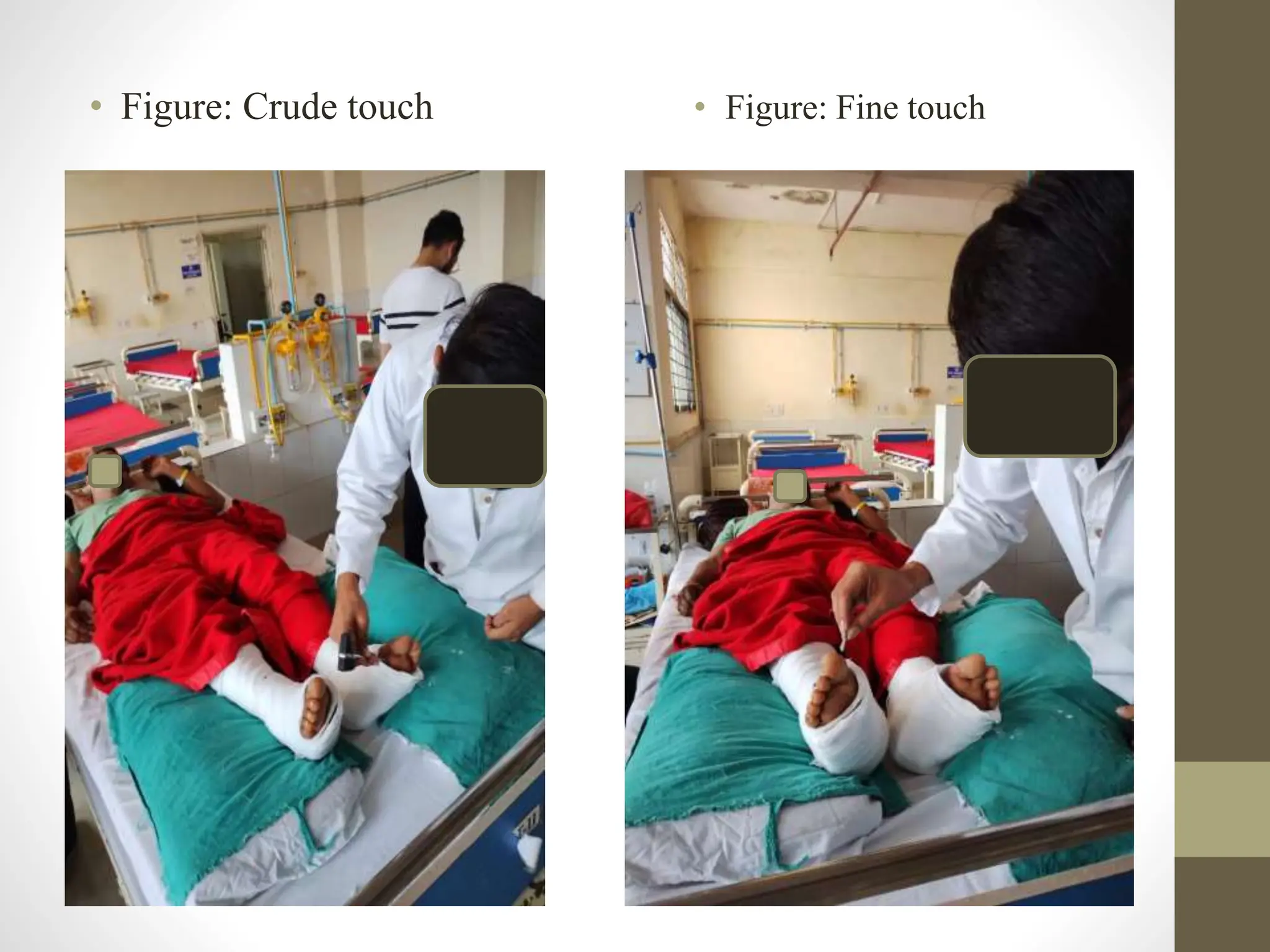 Calcaneus fracture of bilateral feet: Examination, Investigation ...