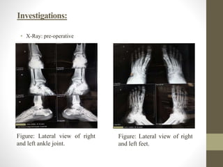 Calcaneus fracture of bilateral feet: Examination, Investigation ...