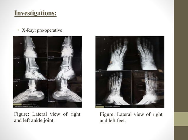 Calcaneus fracture of bilateral feet: Examination, Investigation ...