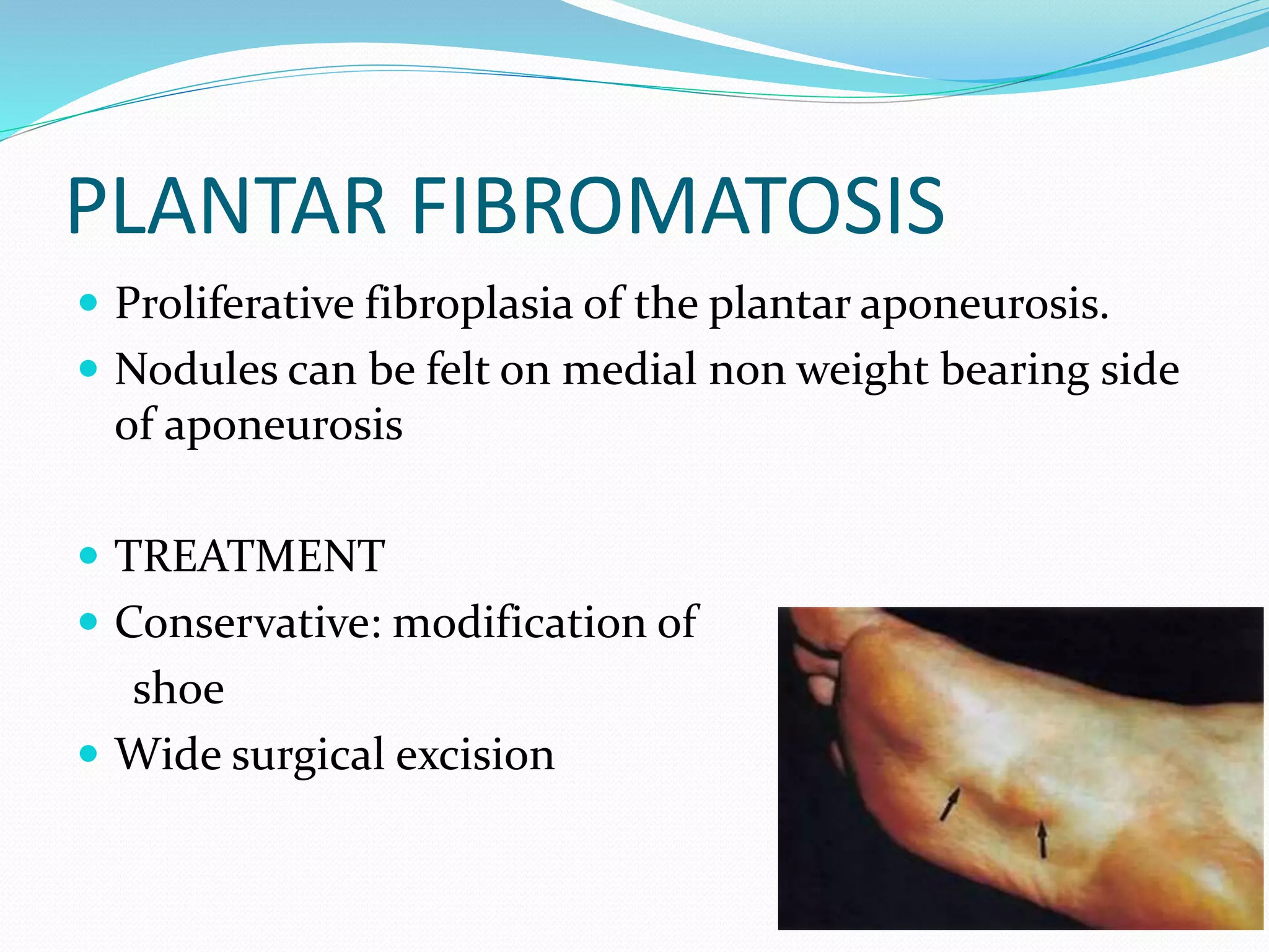 Heel pain and plantar fasciitis | PPTX