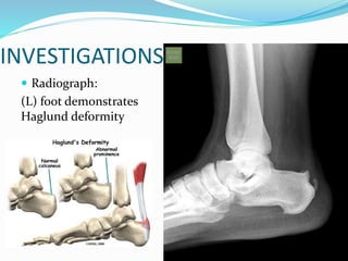 Heel pain and plantar fasciitis | PPTX