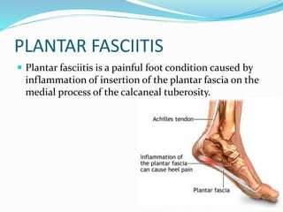 Heel pain and plantar fasciitis | PPTX