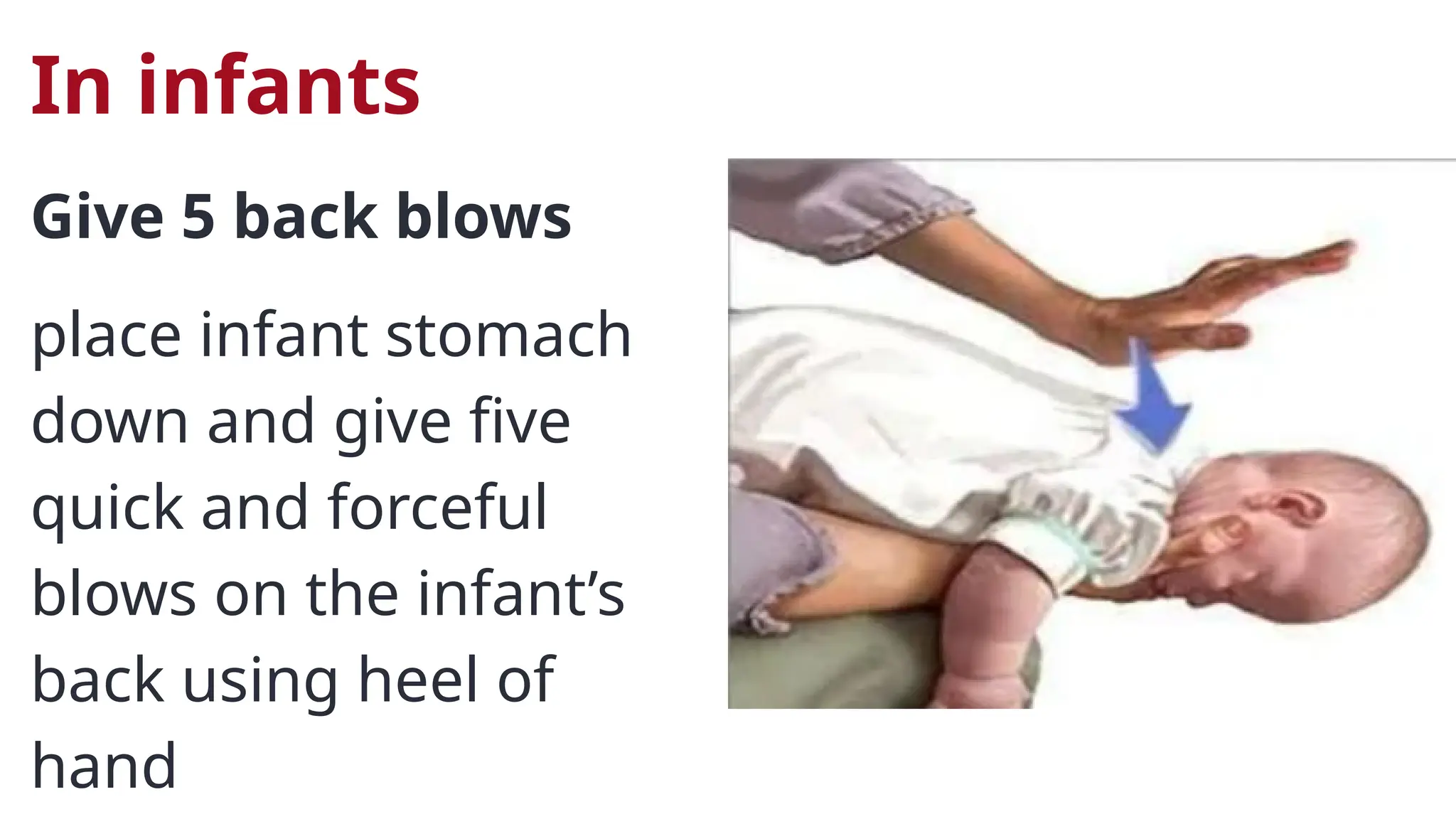 heimlich maneuver- technique for choking incidents | PPTX