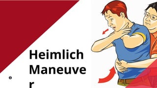 heimlich maneuver- technique for choking incidents | PPTX
