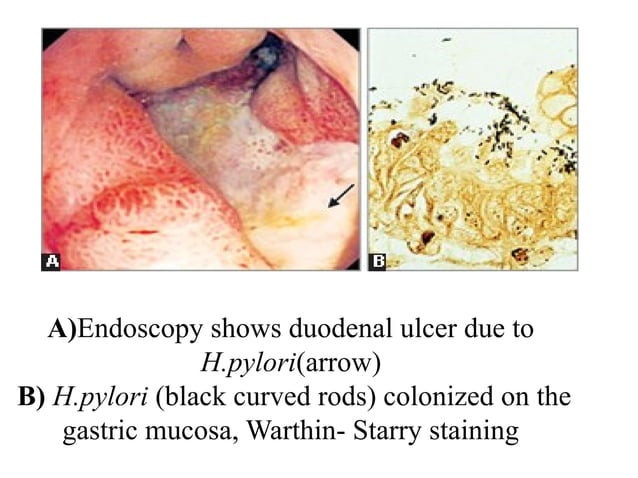 HELICOBACTER PYLORI by Dr Teena Varghese. pptx | PPT