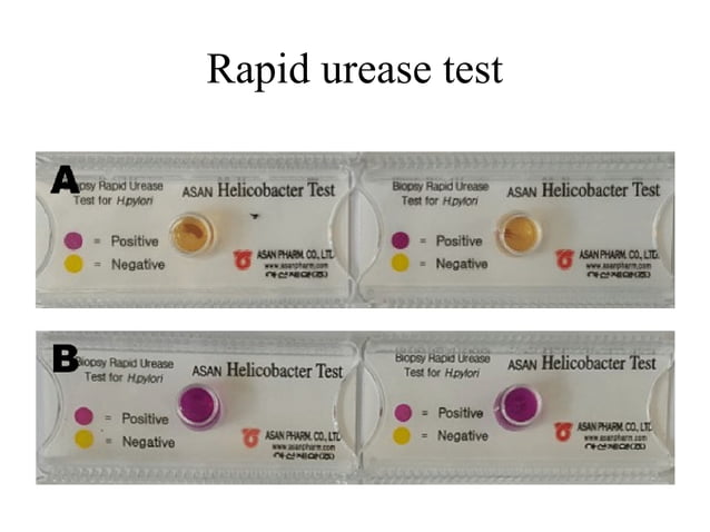 HELICOBACTER PYLORI by Dr Teena Varghese. pptx | PPT