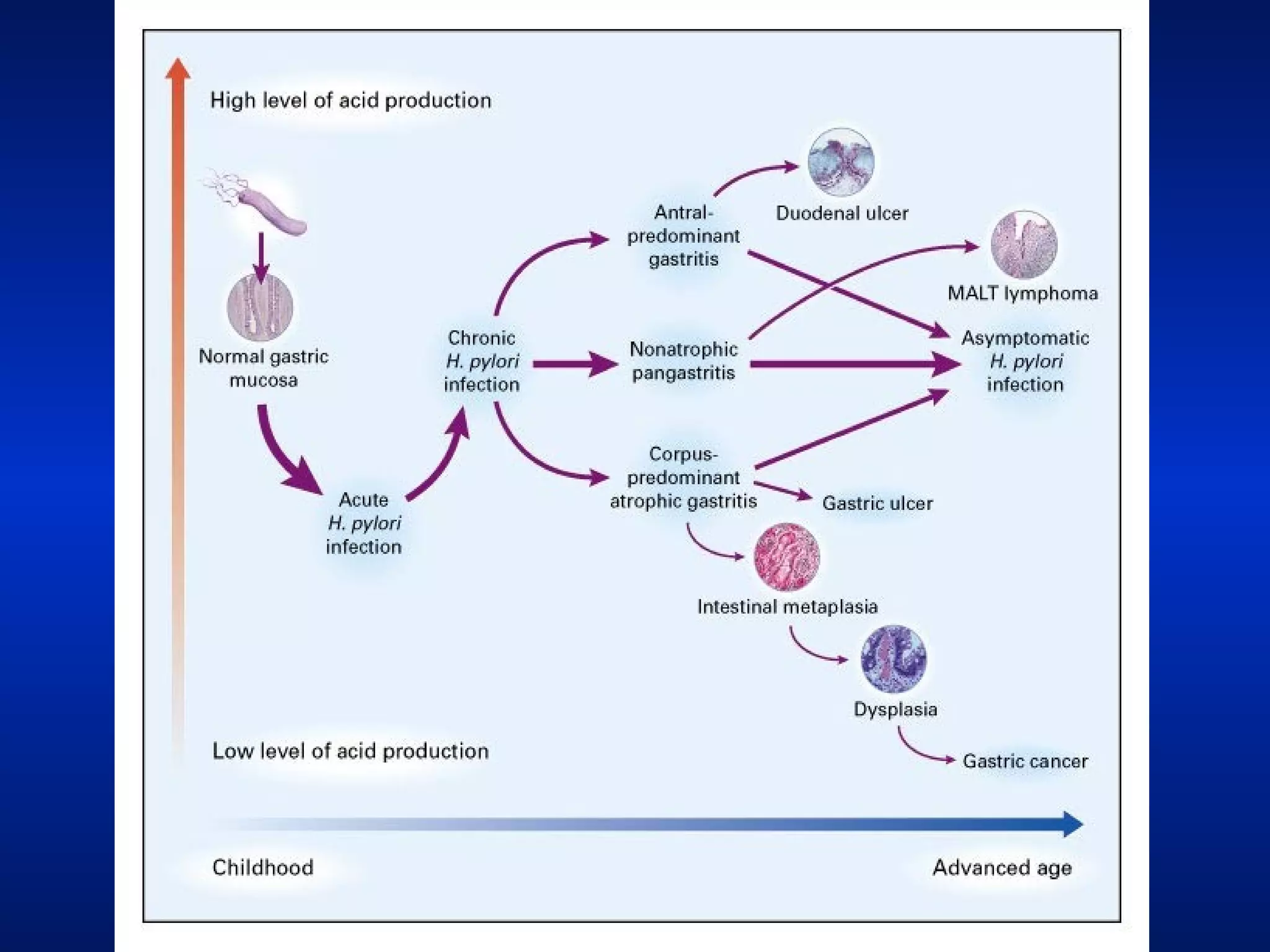 Helicobacter pylori | PPT