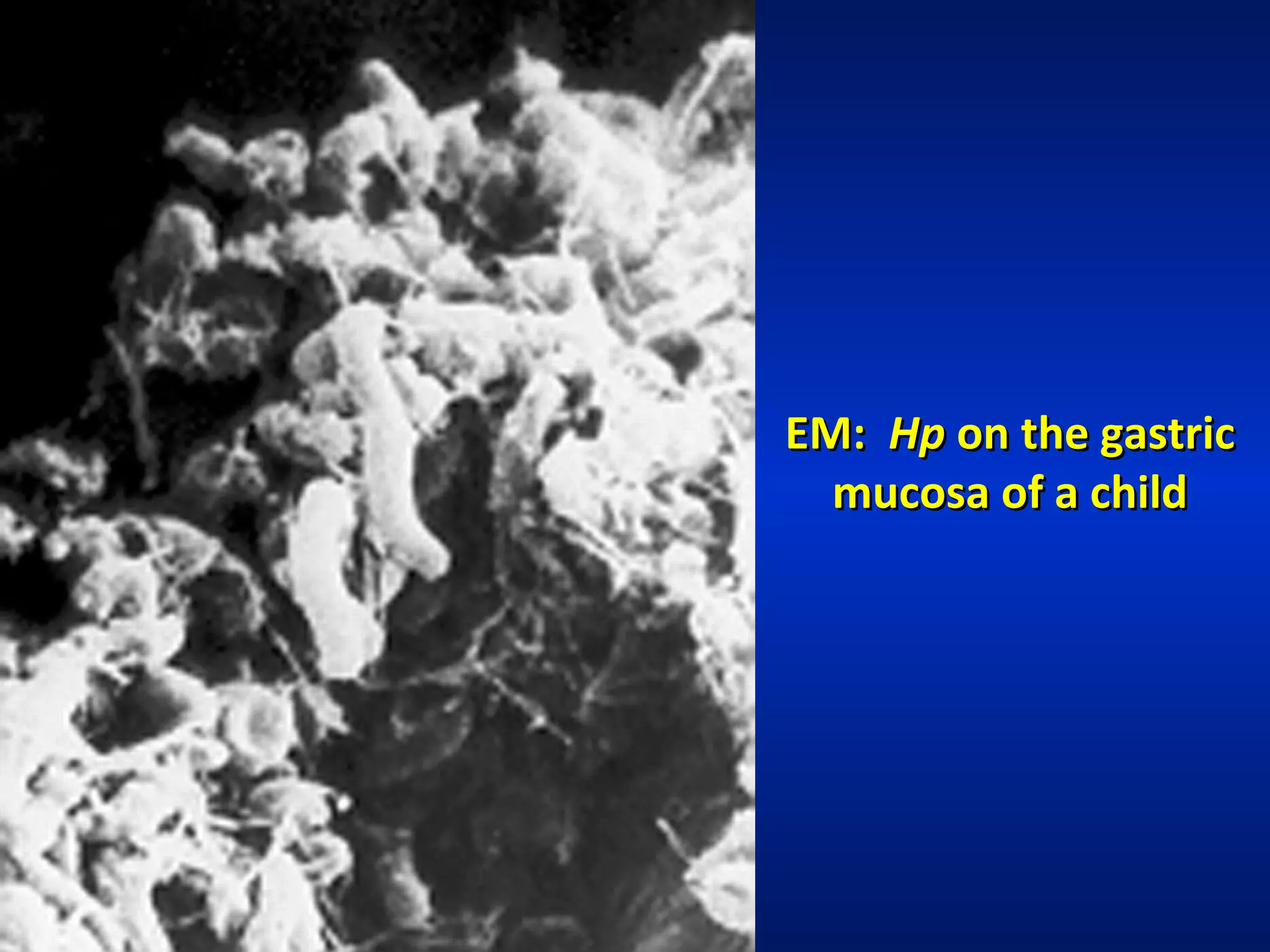 Helicobacter pylori | PPT