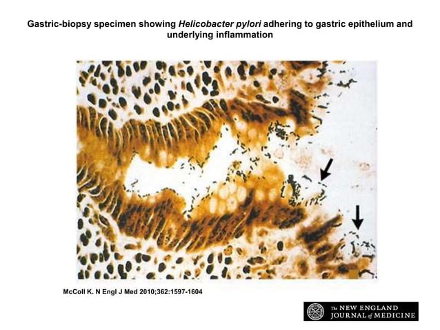 Helicobacter pylori .pptx