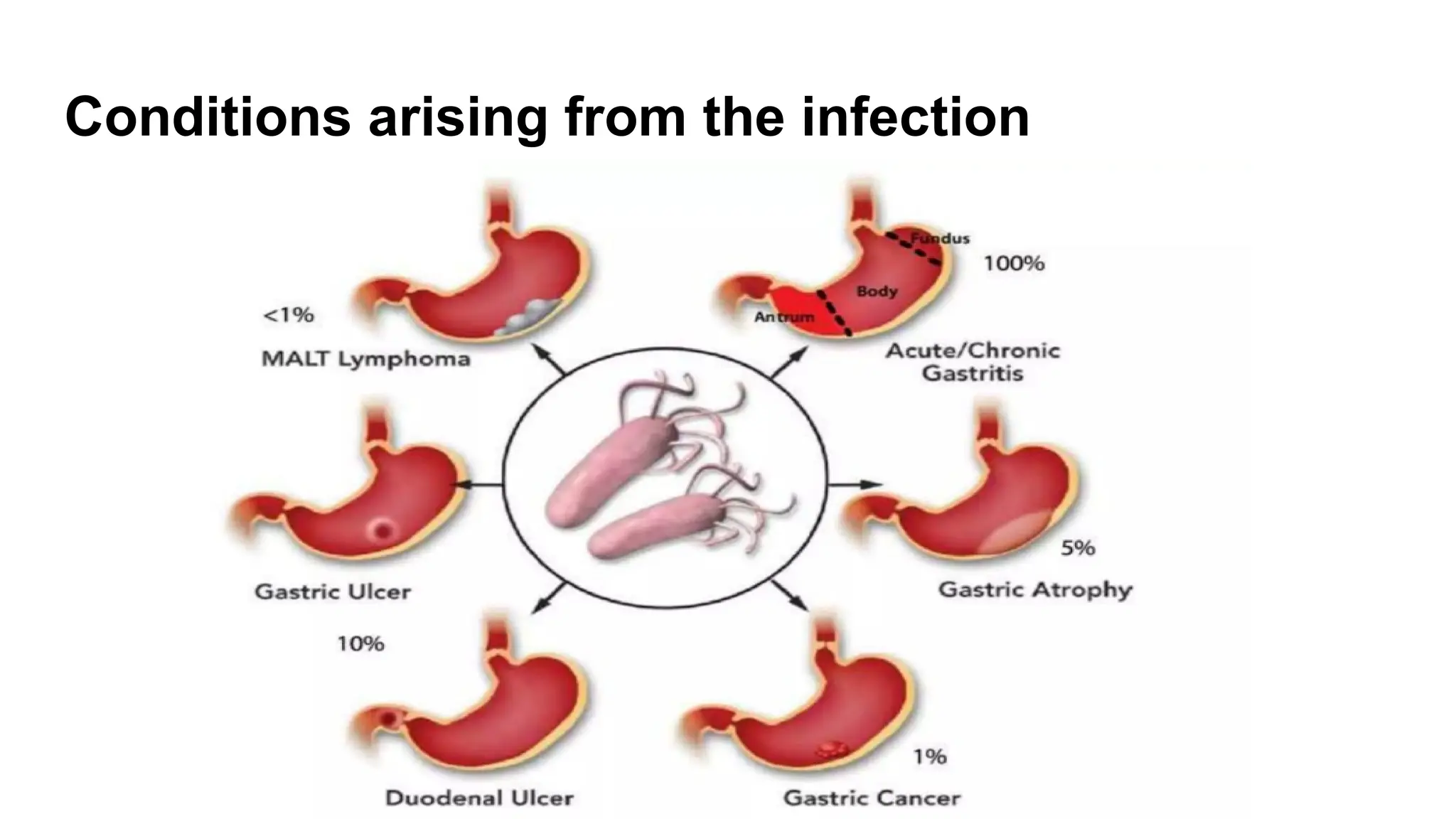 helicobacter pylori by medical officer.pptx
