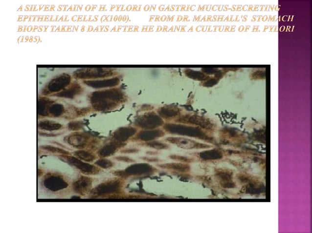 Helicobacter pylori bhavesh dr | PPTX