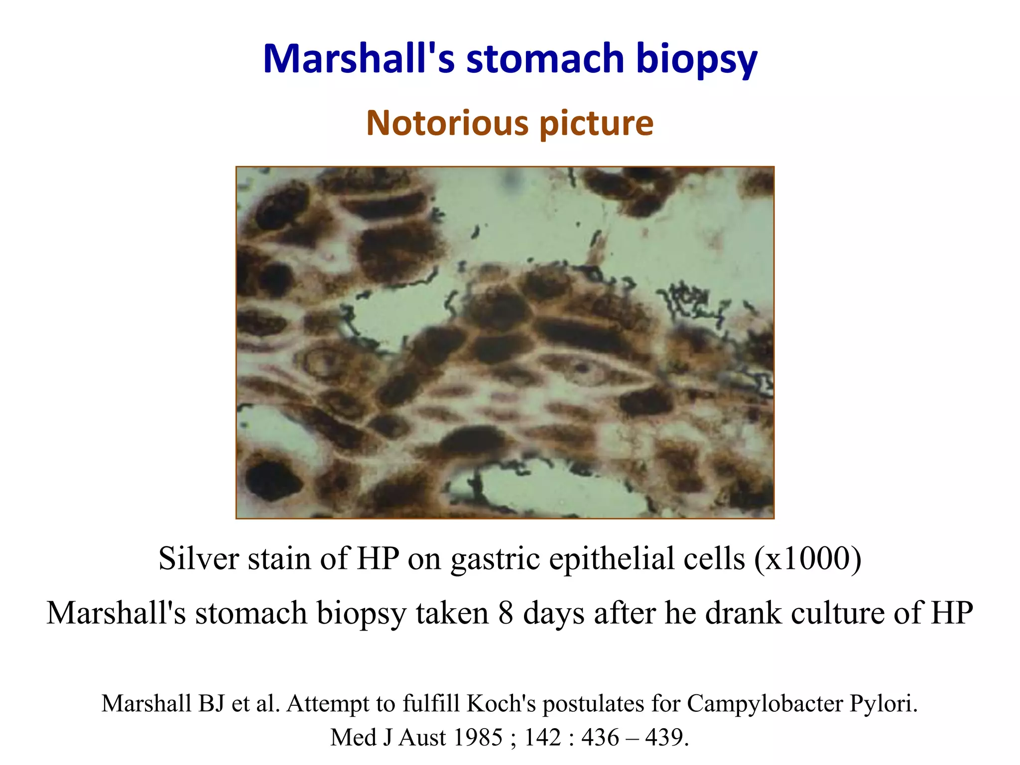 Helicobacter pylori infection | PPTX