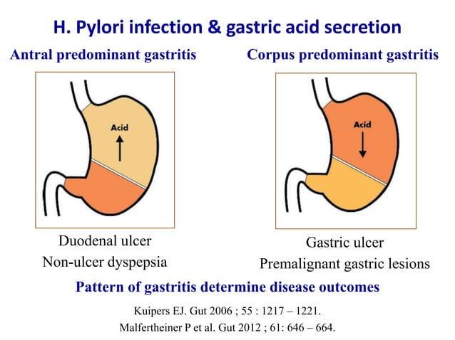Helicobacter pylori infection | PPTX