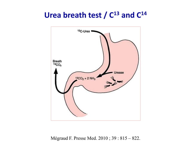 Helicobacter pylori infection | PPTX
