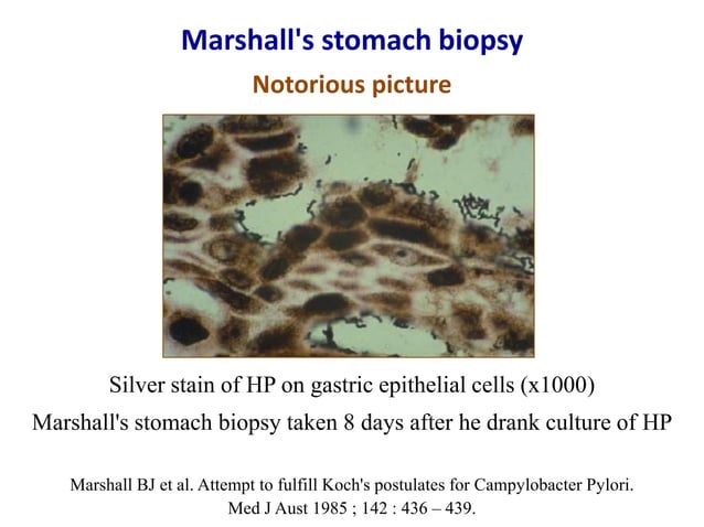 Helicobacter pylori infection | PPTX
