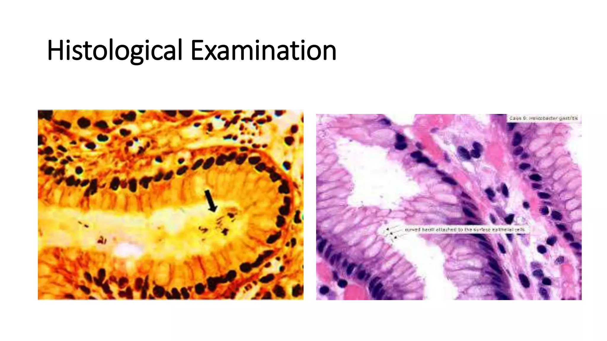 Helicobacter pylori & Its role in Peptic Ulcer.pptx